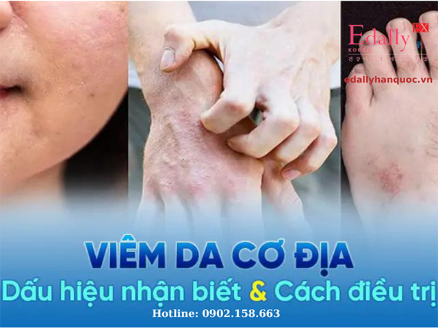 Bệnh Viêm Da Cơ Địa Là Gì? Cách Chữa Viêm Da Cơ Địa Tại Nhà Hiệu Quả?